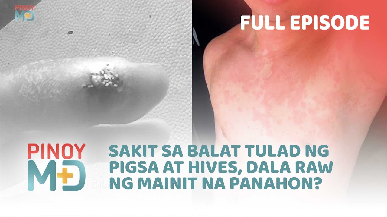 Sakit sa balat tulad ng pigsa at hives, dala raw ng mainit na panahon ...