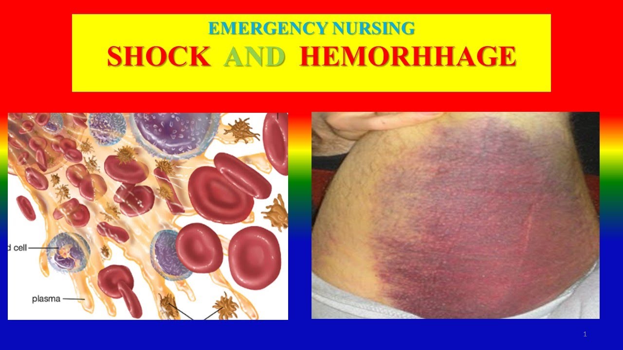 SHOCK & HEMORRHAGE - Emergency Nursing - define ,causes ...