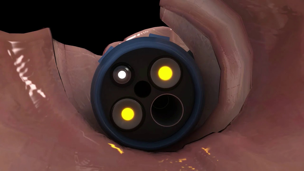 Endo-Wing : Capuchon distal permettant d'améliorer la vision ...