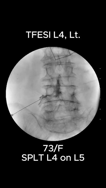 How to Accurately Perform L4 Transforaminal Epidural Steroid Injection (TFESI) (1) - YouTube