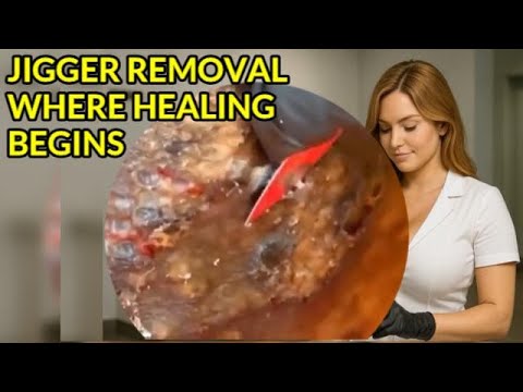 Immediate Healing Through Jigger Removal