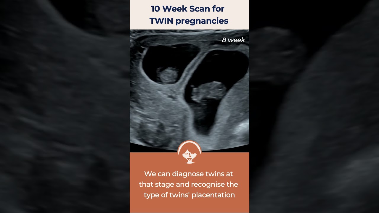 10 Week Scan for Twins. - YouTube