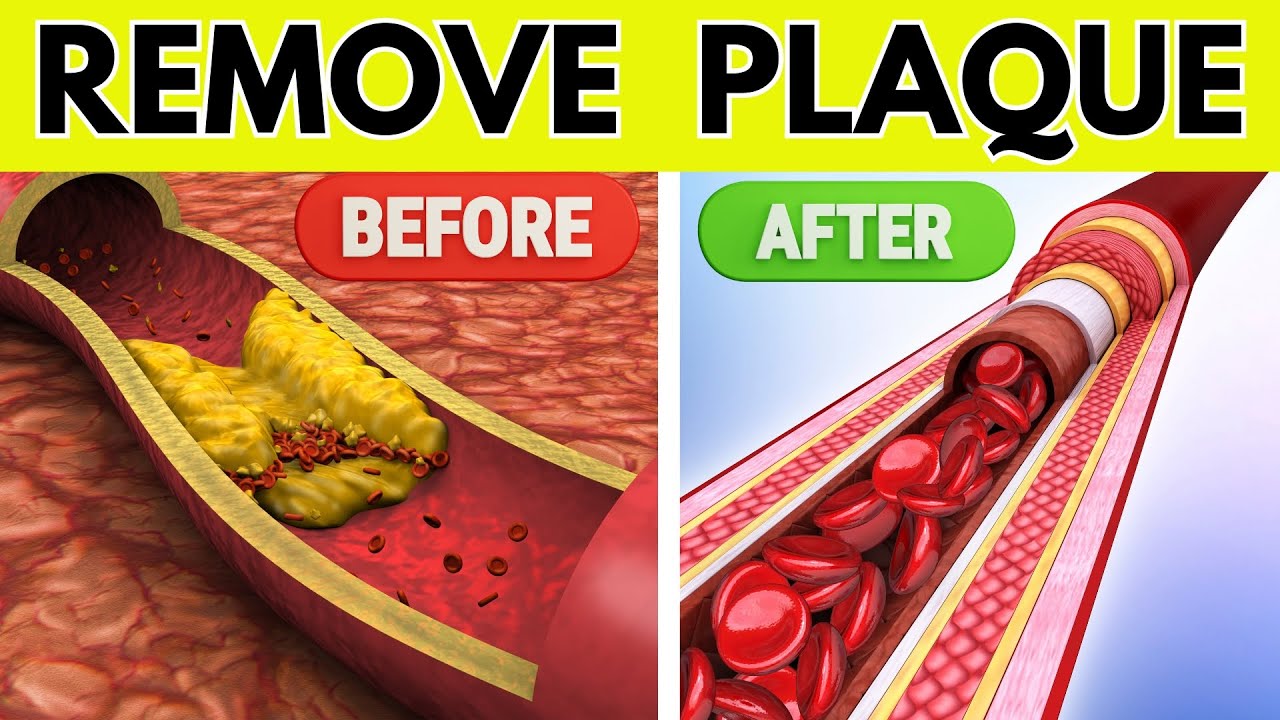 10 Nutrients to Remove Plaque from Arteries Naturally Without ...