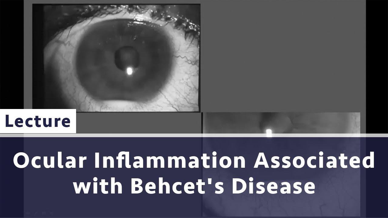 Ocular Inflammation Associated with Behcet's Disease - YouTube