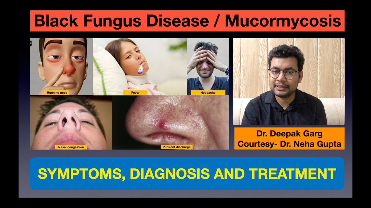 WHAT IS MUCORMYCOSIS OR BLACK FUNGUS DISEASE? HOW TO DIAGNOSE IT? HOW ...