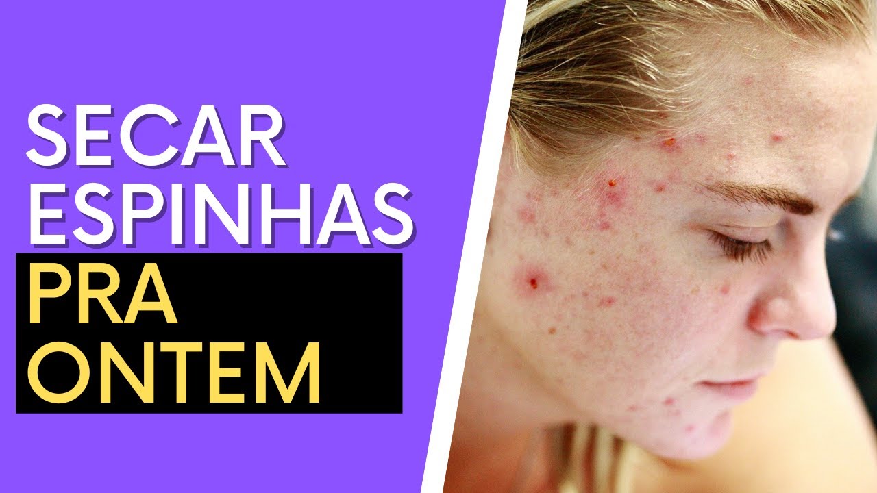 COMO SECAR ESPINHA EM MINUTOS (3 Dicas Infalíveis e Testadas) - YouTube
