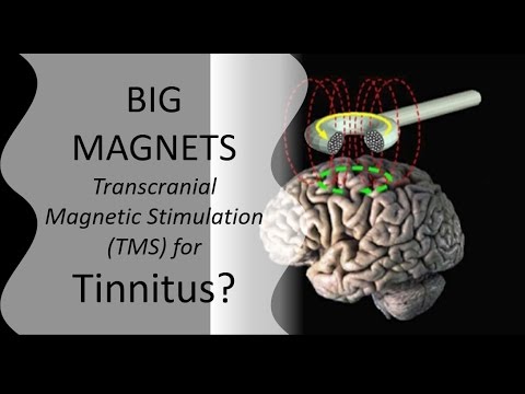 BIG Magnets for Tinnitus - Does TMS-TransCranial Magnetic Stim. (TMS ...