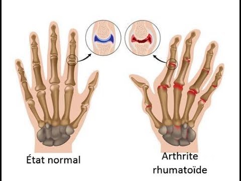 L’arthrite rhumatoïde : comment en contrôler les symptômes ? - YouTube