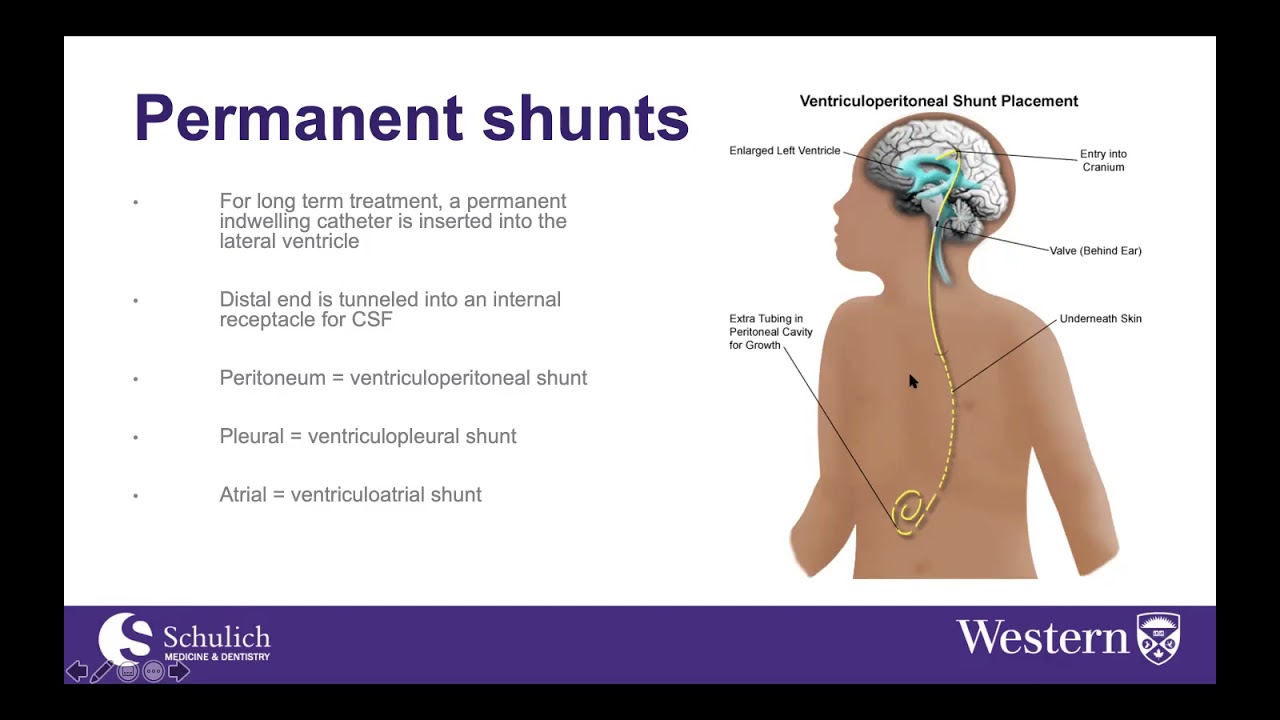 Anesthesia for CSF shunting procedures - YouTube