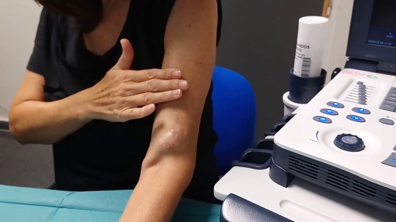 Autoexploración diaria de la fístula: fístula arteriovenosa con ...