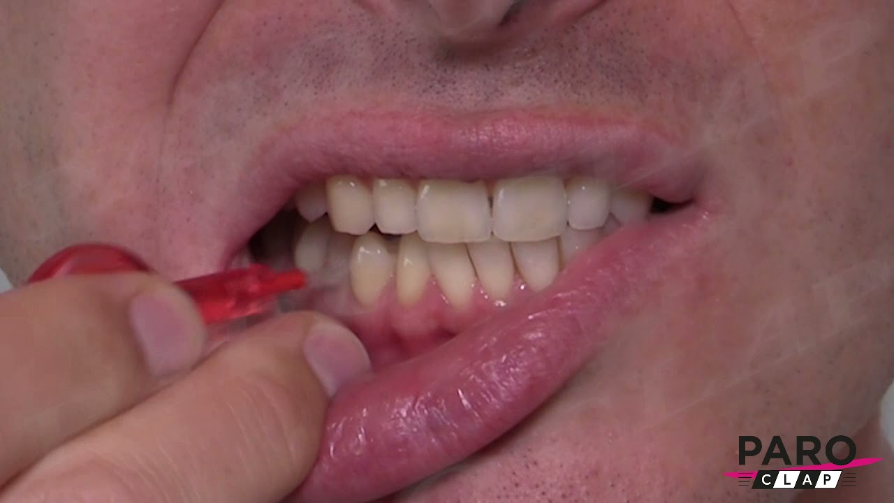 Une minute au quotidien, pour un parodonte sain! - YouTube