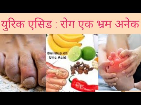 Uric acid and Myths in Nepali| Dr Bhupendra shah | doctor sathi