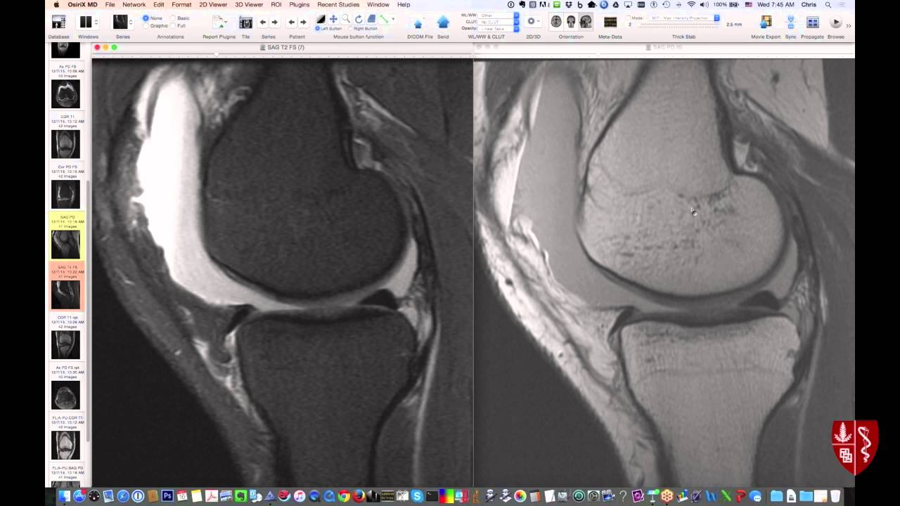 Knee MRI Supplemental Cases, Part 2 - YouTube