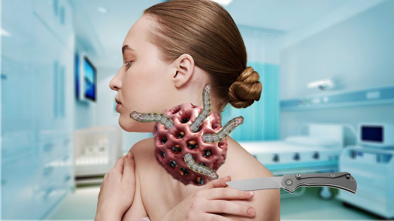 Infected Neck ASMR | 2D & 3D Cartoon Animation | Neck treatment ...
