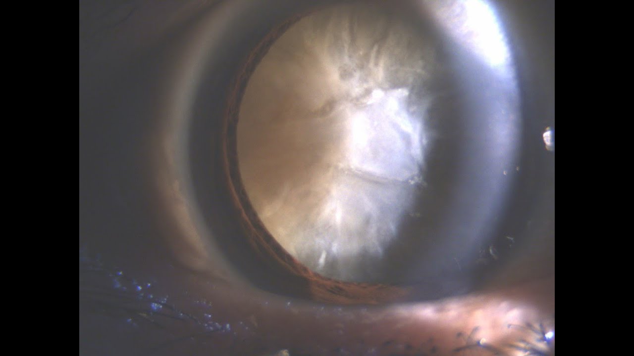 white cataract surgery, eyhance toric IOL, anterior capsule adhesion ...