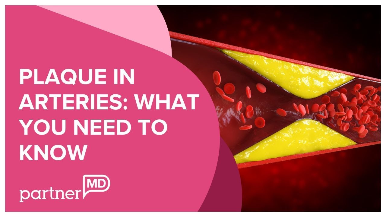 Artery Plaque Explained: How It Forms & How to Stop It - YouTube