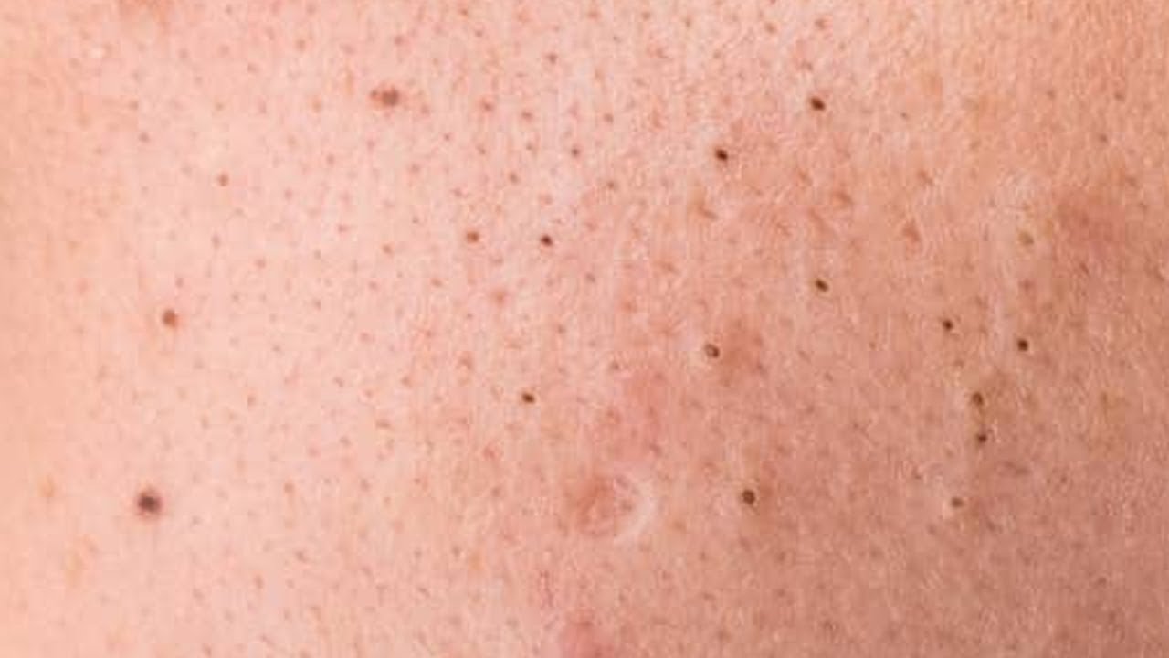 How To Remove Blackheads And Whiteheads On Face Easy #29 Dr Laelia ...