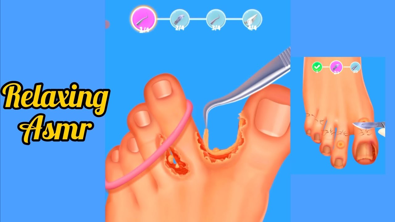 ASMR real sound, ingrown toenail removal treatment animation - YouTube