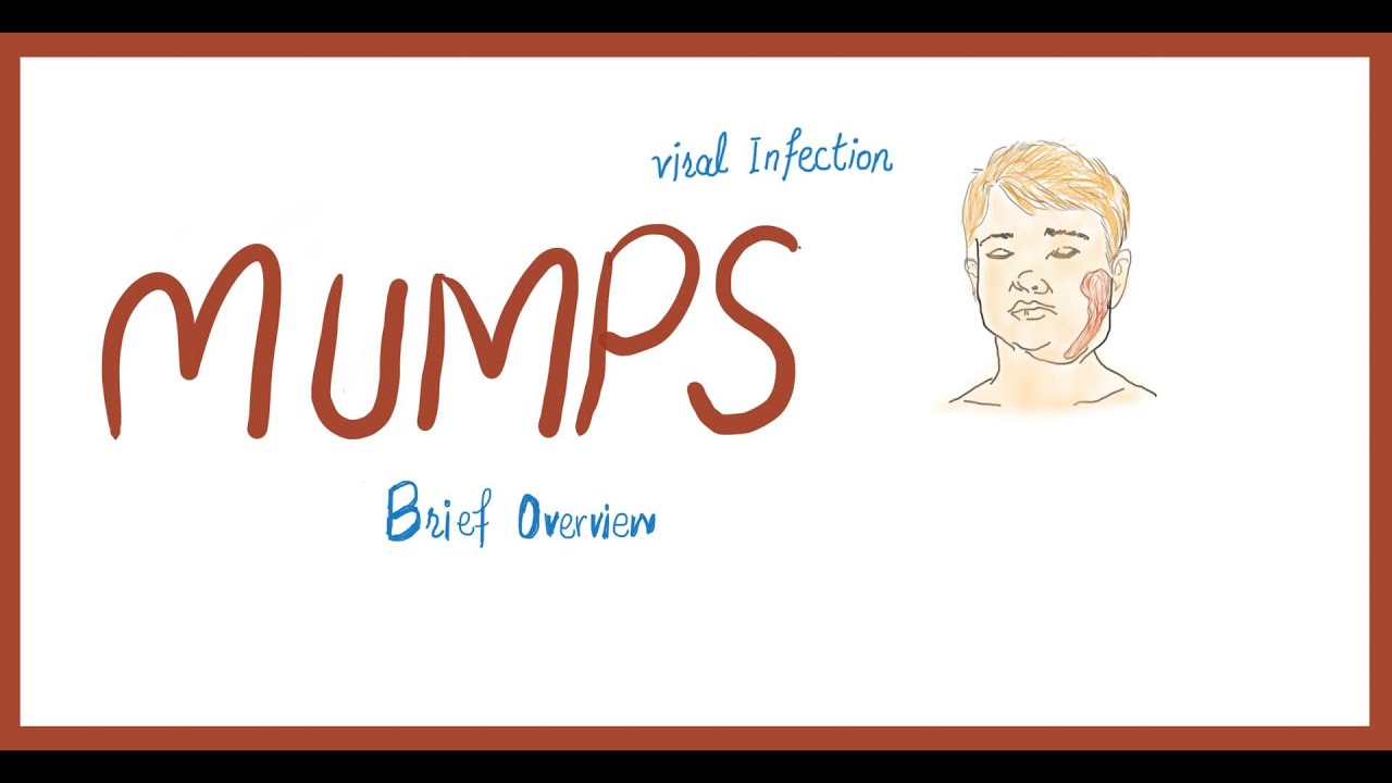 Mumps - causes , signs and symptoms , differential diagnoses , labs ...