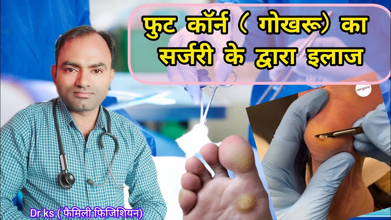 Foot corne removal surgery l foot callus in remove l foot corne surgery ...