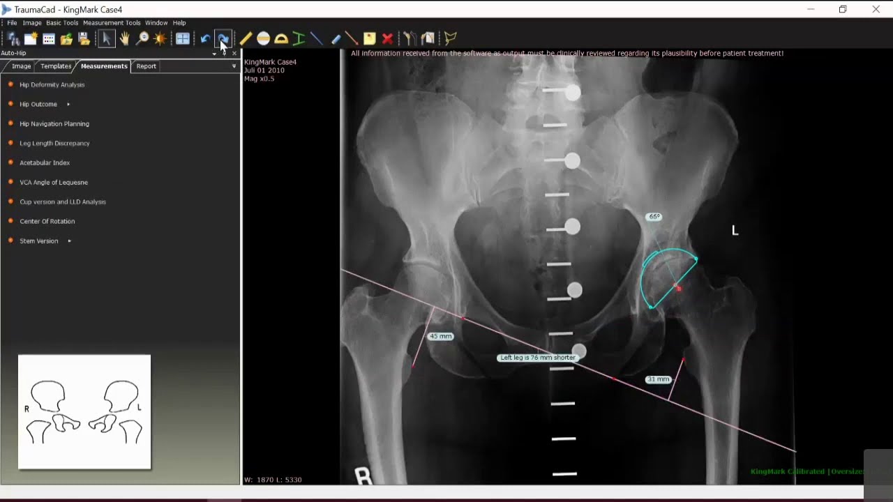 Getting started with TraumaCad Webinar - YouTube