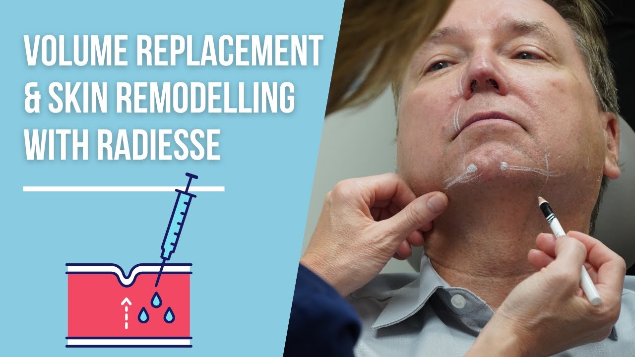 Radiesse - Skin Laxity Dermal Remodeling - YouTube