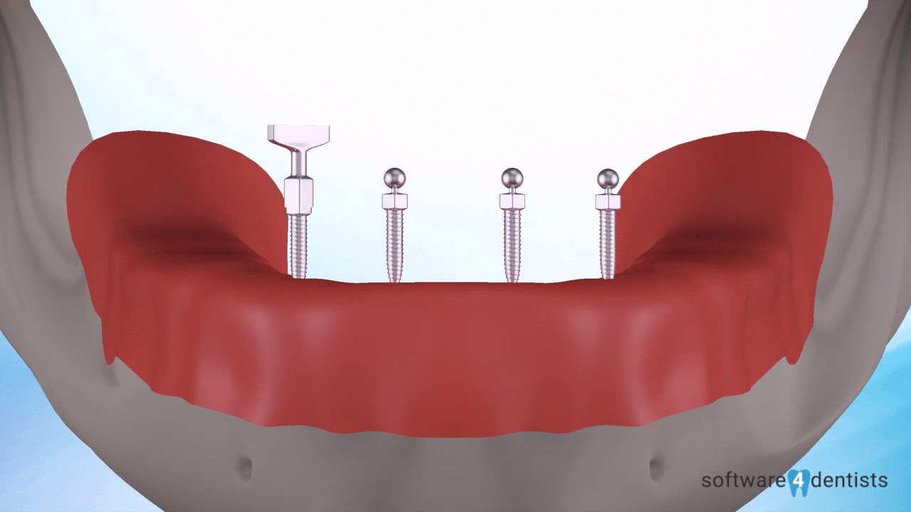 Overdenture operations with balls - YouTube