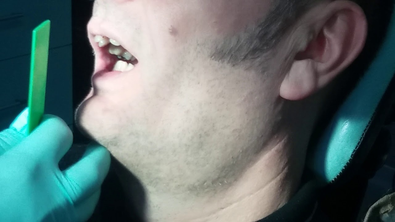 Proba proteza dentara (Inregistrarea DVO)si proba de culoare-DVO dental ...