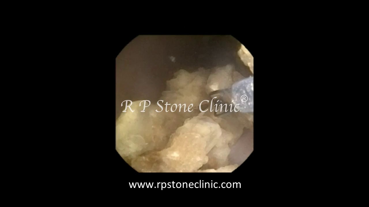 The Video shows Basketing and removal of Kidney Stone Fragments after ...