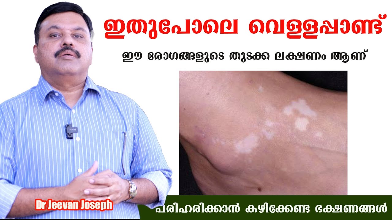 ഇതുപോലെ വെള്ളപ്പാണ്ട് ഈ രോഗങ്ങളുടെ തുടക്ക ലക്ഷണം ആണ് .ഇത് പരിഹരിക്കാ ...
