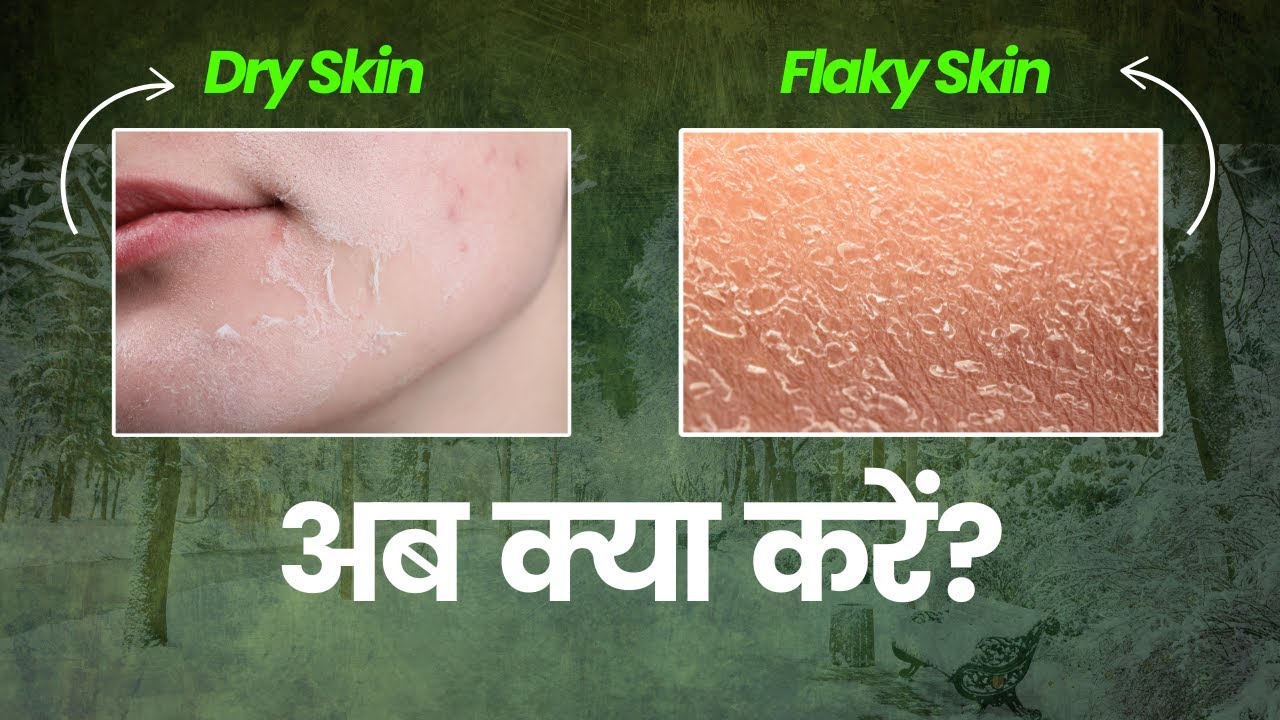 Winter Care Tips: Natural Remedies to Reduce Skin Dryness in Cold Months