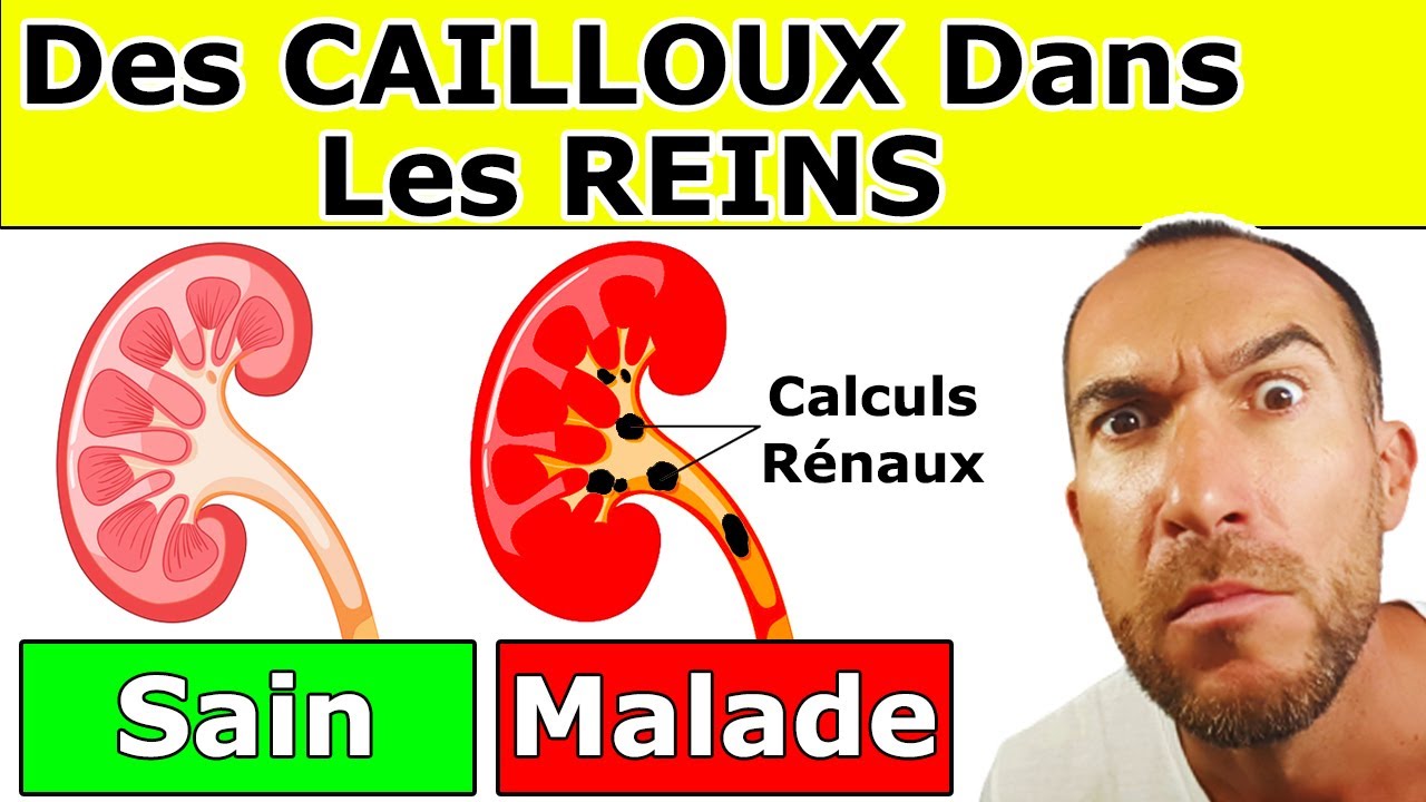 CALCULS RÉNAUX : Causes, Symptômes, Aliments Interdits et Remèdes ...