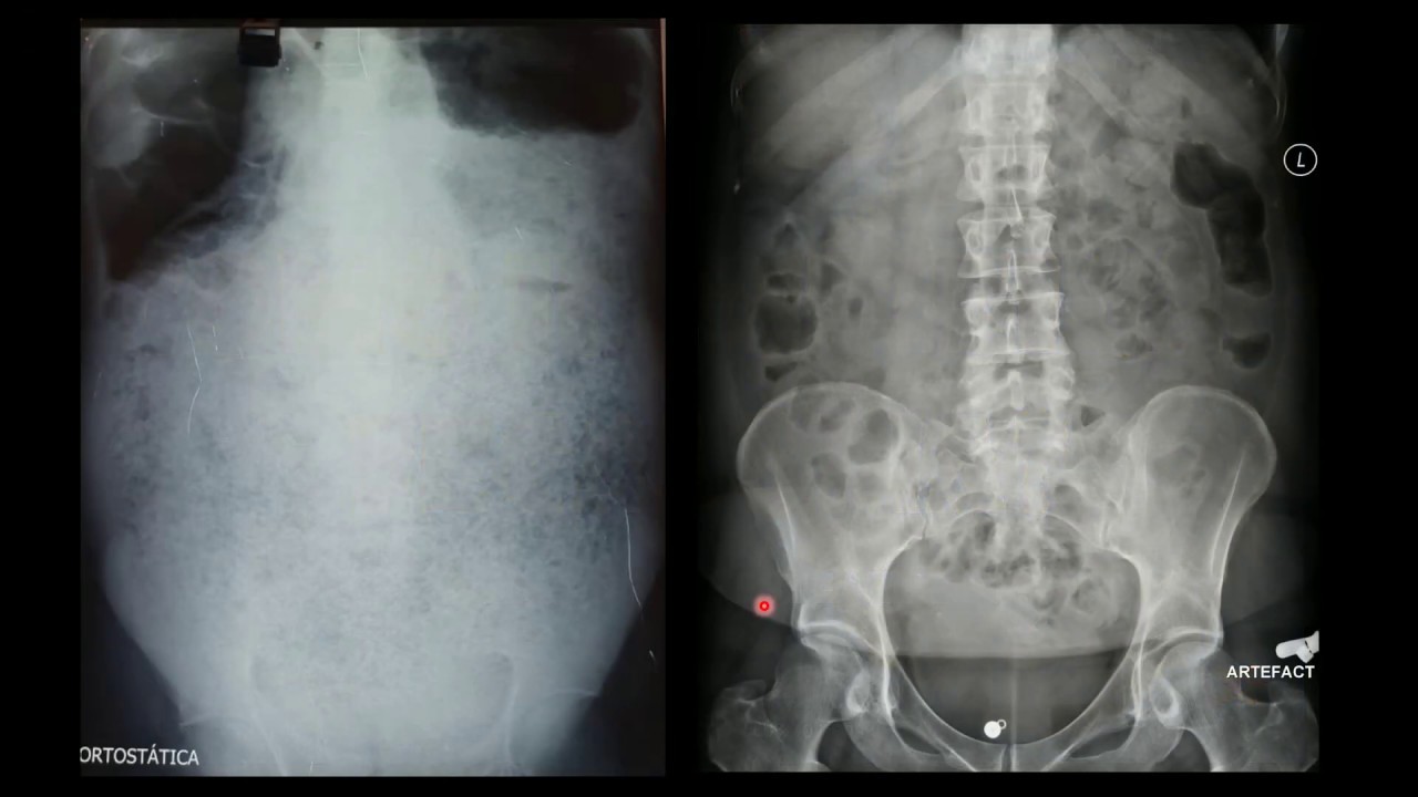 COMO IDENTIFICAR FECALOMA NO RX ? - YouTube