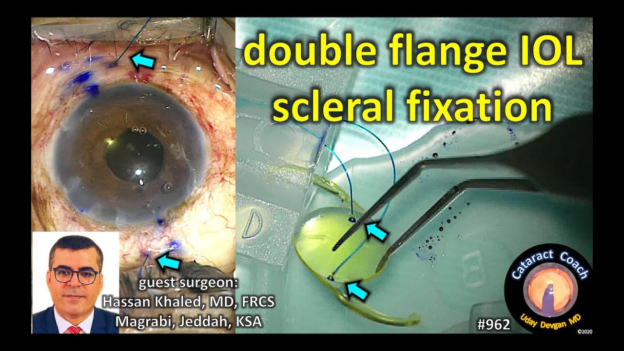 double flange IOL scleral fixation technique with single-piece acrylic ...