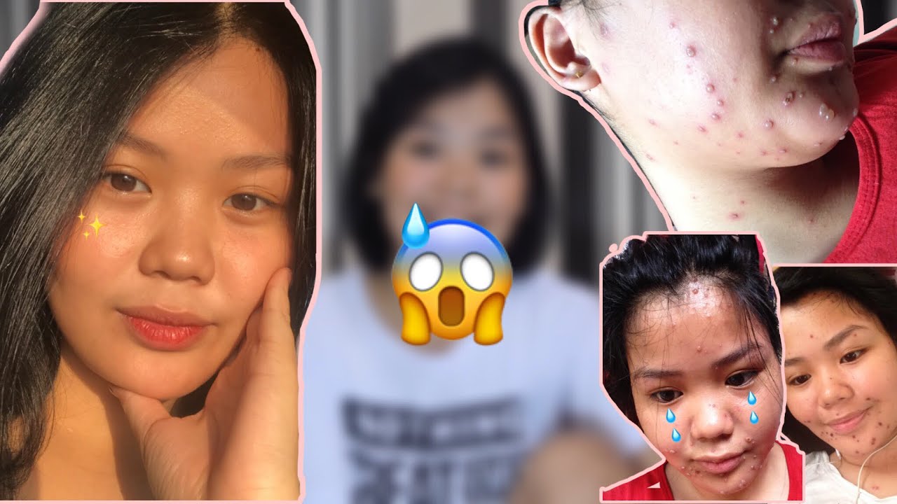PAANO NAWALA YUNG MGA PEKLAT NG BULUTONG KO?(Tips on how I get rid off ...