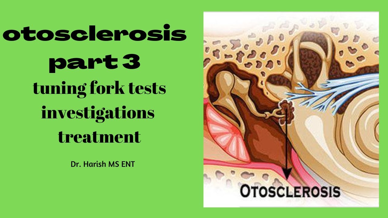 otosclerosis part 3/4 | tuning fork tests, investigations, treatment ...