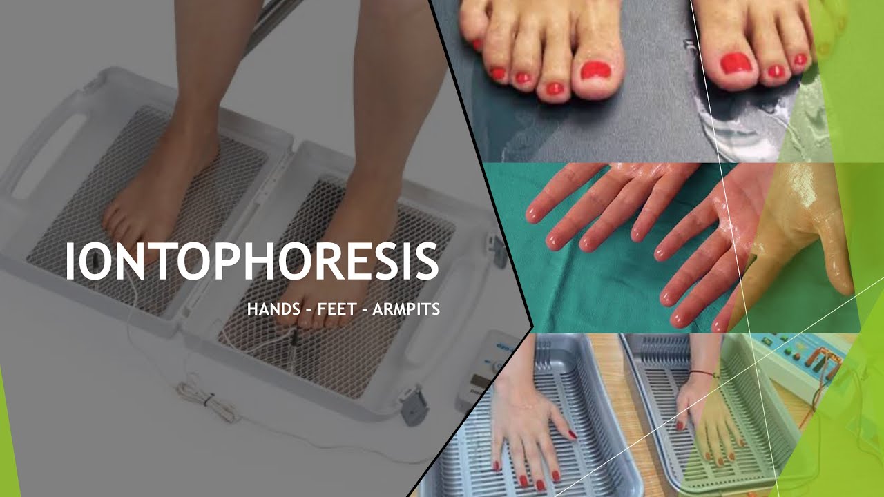 Excessive SWEATING (Hyperhidrosis) and the Relief of IONTOPHORESIS ...