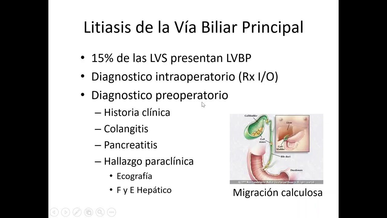 Litiasis de la vía biliar principal y colangitis. - YouTube