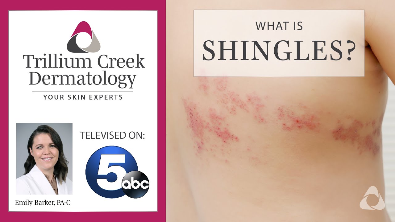 What is Shingles? - YouTube