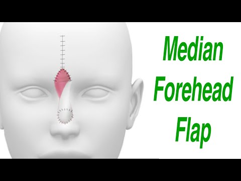 Median Forehead Flap for Nasal Defect Reconstruction - YouTube