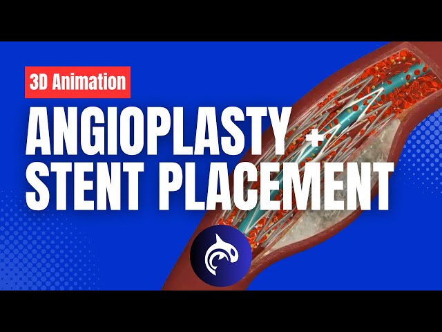 Angioplasty and Stent Placement - 3D Animation