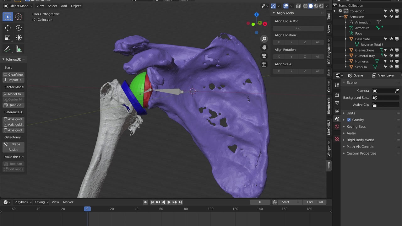 Reverse total shoulder replacement - surgical planning and animation ...