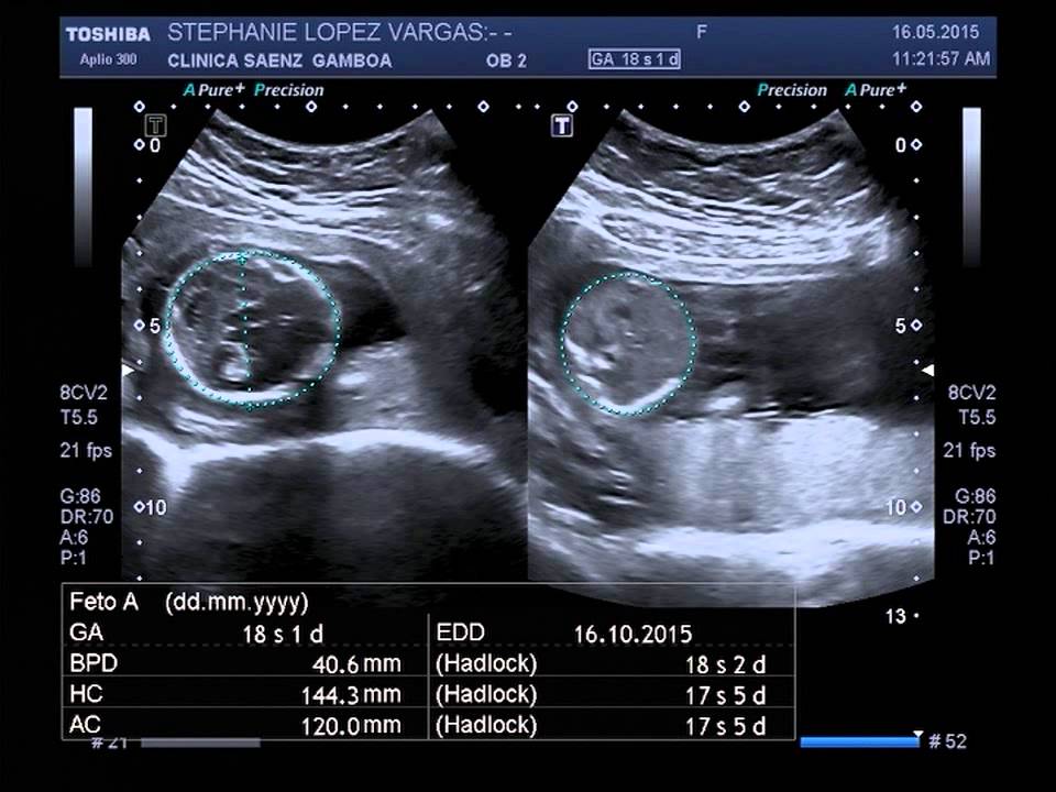 Ultrasonido 2D,3D,4D 18 semanas de mi Diego - YouTube