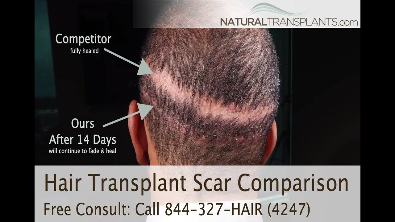 Hair Transplant: Hair Implants Alexandria, VA | HUE℠ Method Hair at Our ...