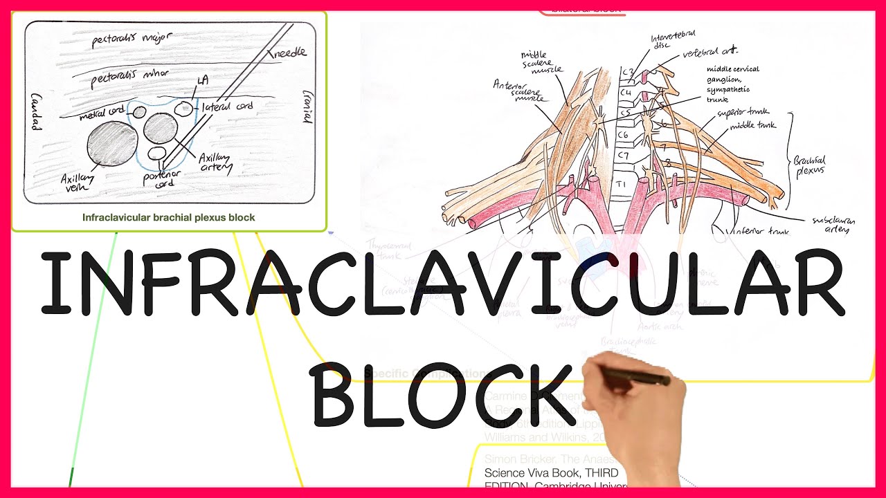 INFRACLAVICULAR BRACHIAL PLEXUS BLOCK -PRACTICAL CONDUCT SERIES - YouTube