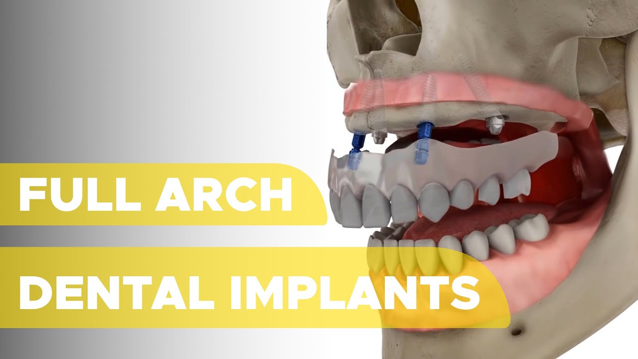 Full Arch Dental Implants - YouTube
