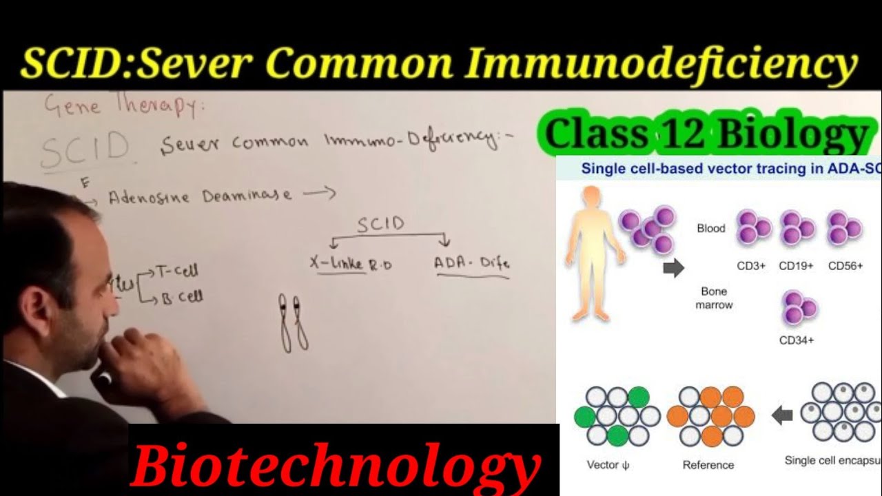 SCID | Severe Common immune deficiency | Gene Therapy | Biotechnology ...