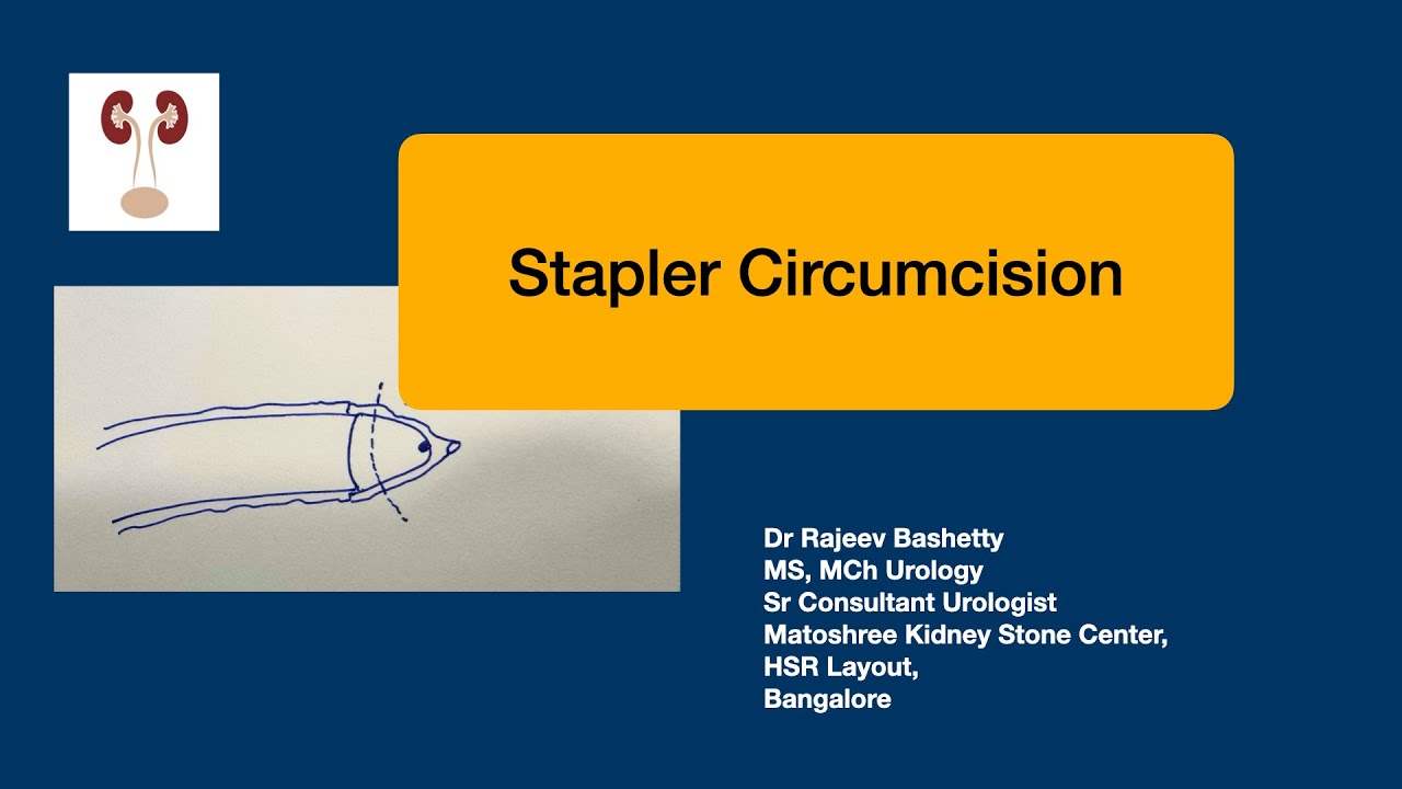 Stapler Circumcision Explained - YouTube