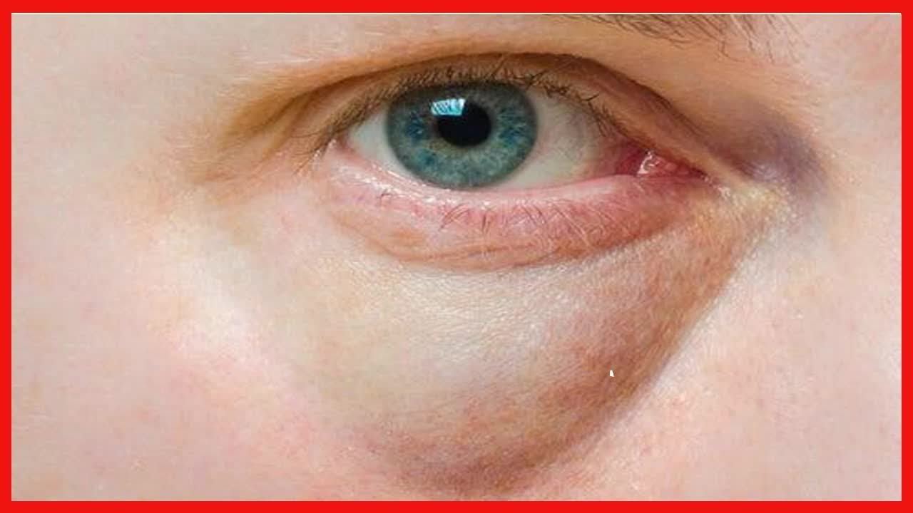 Párpados hinchados: causas y tratamientos - YouTube