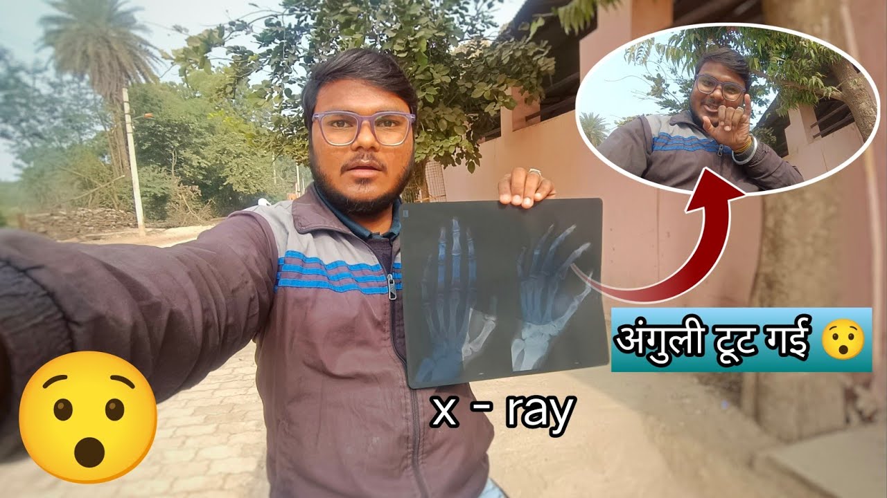 Hath ka x-ray 🩻 ll अंगुली टूट गई 😯 - YouTube